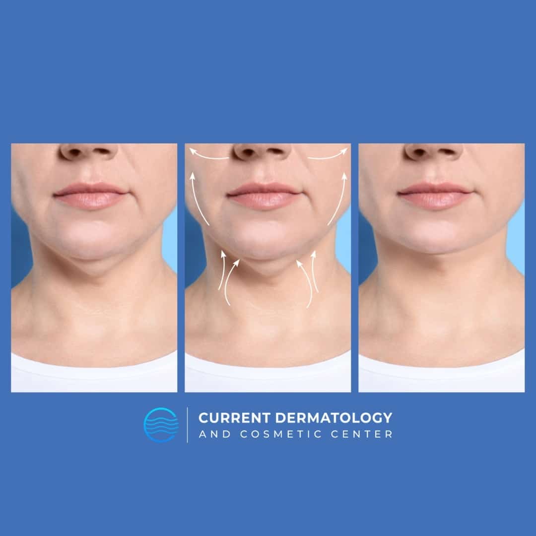 Skin Laxity: How to prevent and treat sagging skin - Annapolis Moms