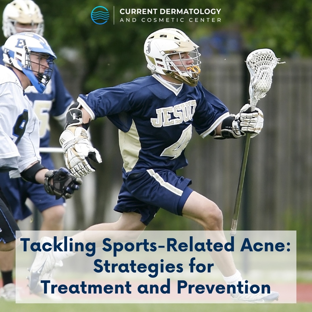 Tackling Sports-Related Acne: Strategies for Treatment and Prevention ...